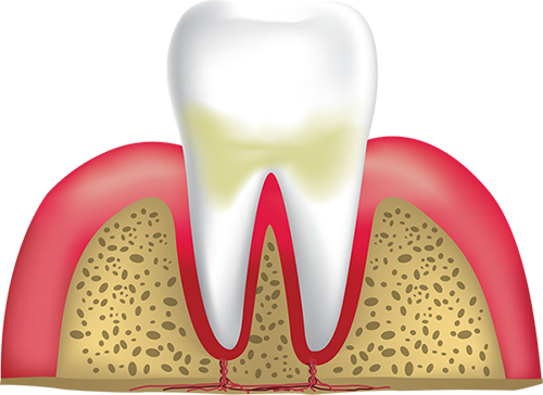 gingivitis – Advanced Dental Care of Falmouth